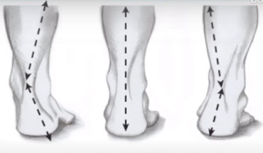 SUPINACJA i PRONACJA - co to jest? - Zdrowa Stopa Obuwie Zdrowotne Warszawa